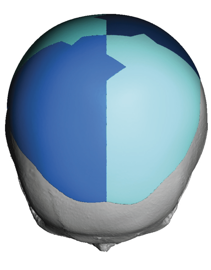 Plastic Surgey Case Study - Large Four Piece Skull Implant for Back and ...