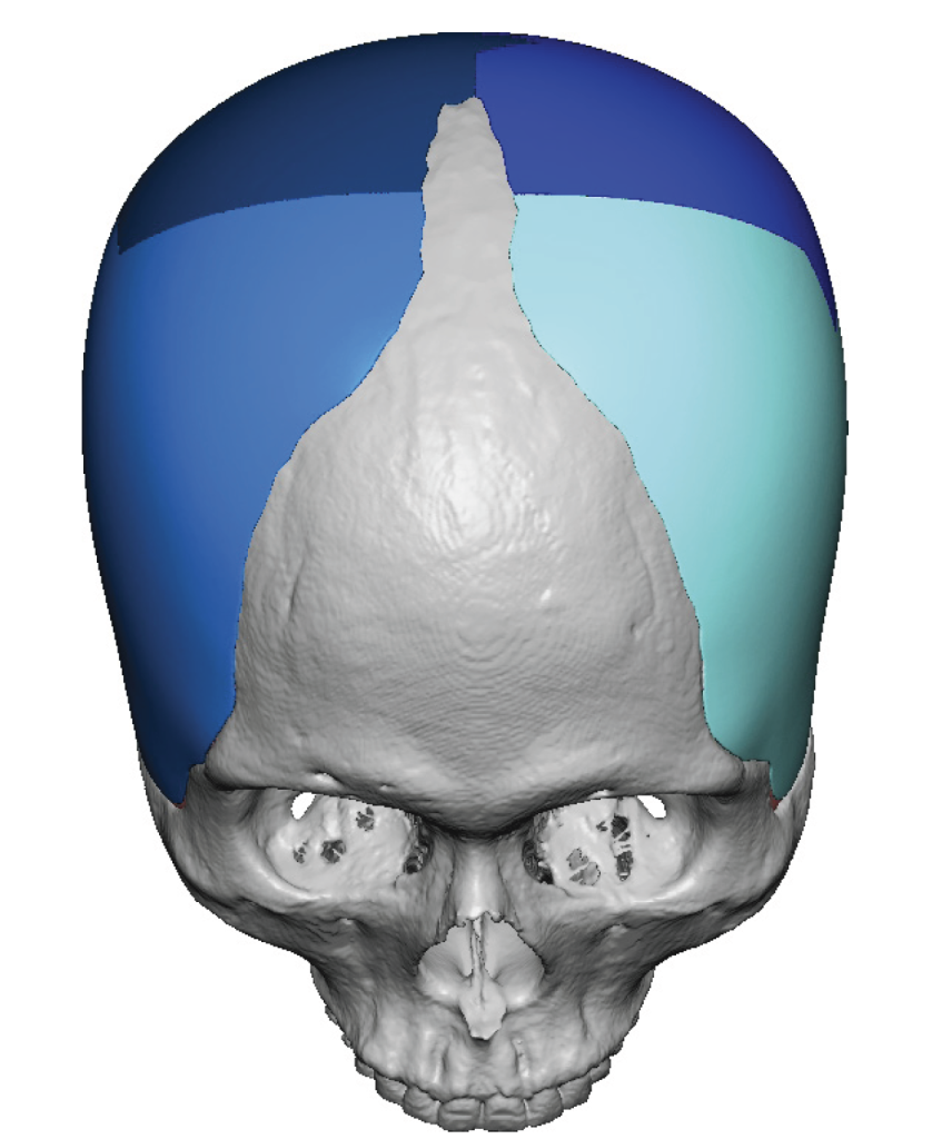 Plastic Surgery Case Study - Large Four Piece Head Widening Implant ...