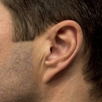 facelift Archives - Explore Plastic Surgery