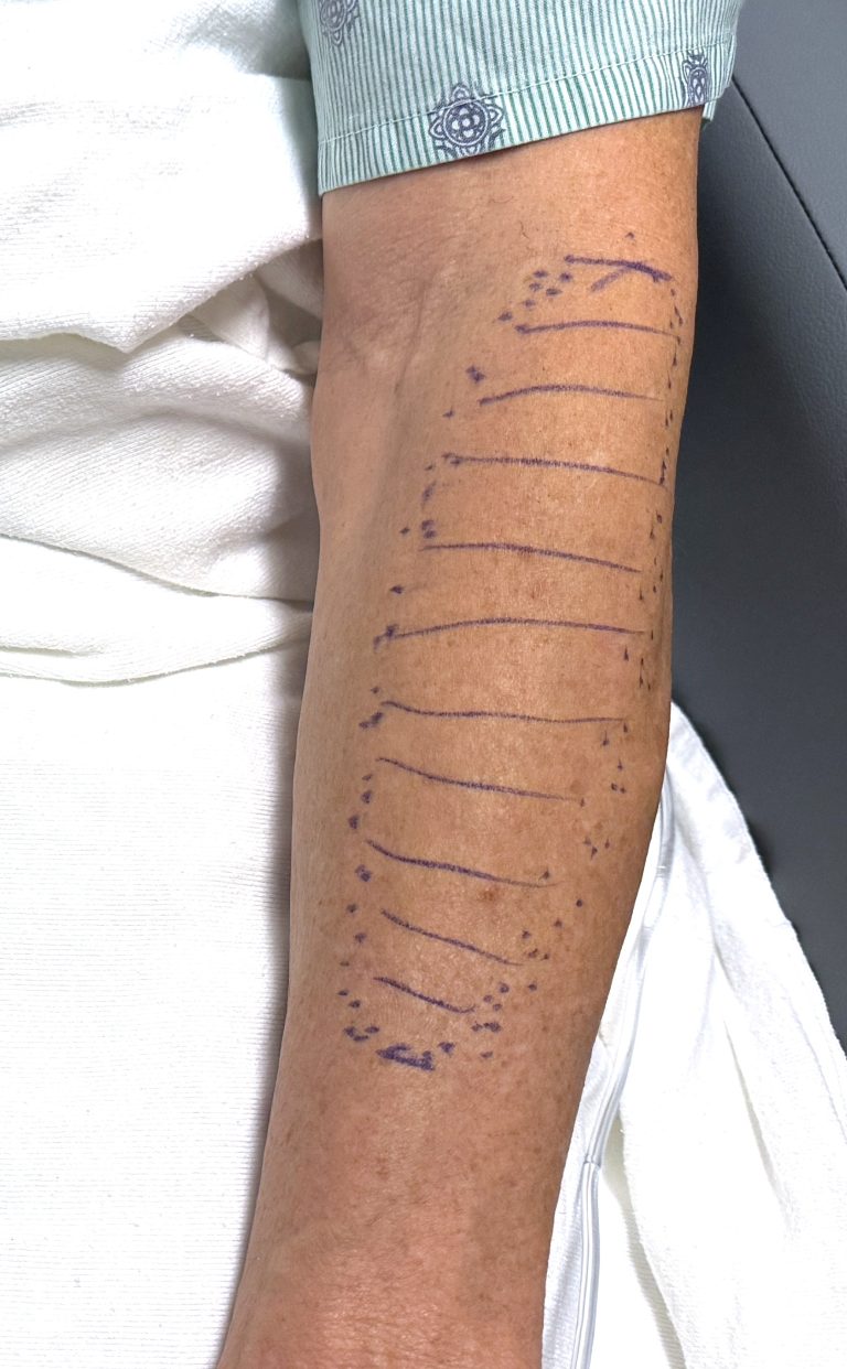 Plastic Surgery Case Study - Bilateral Upper Forearm and Right Volar ...