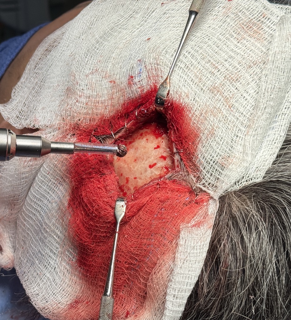 Technical Strategies - Bilateral Parietal-Temporal Skull Excisions for ...