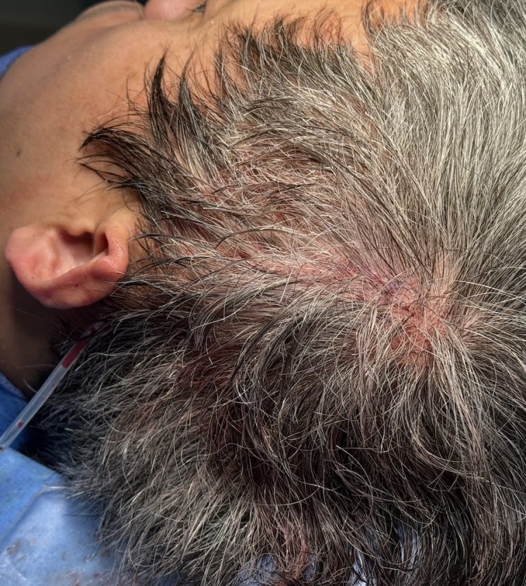 Technical Strategies - Bilateral Parietal-Temporal Skull Excisions for ...