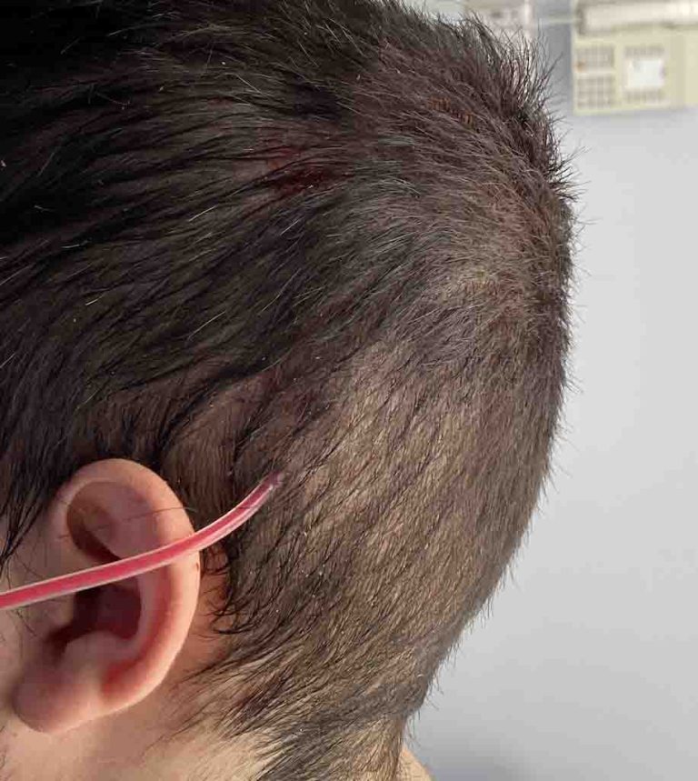 Plastic Surgery Case Study - Male Occipital Skull Reduction Through A ...