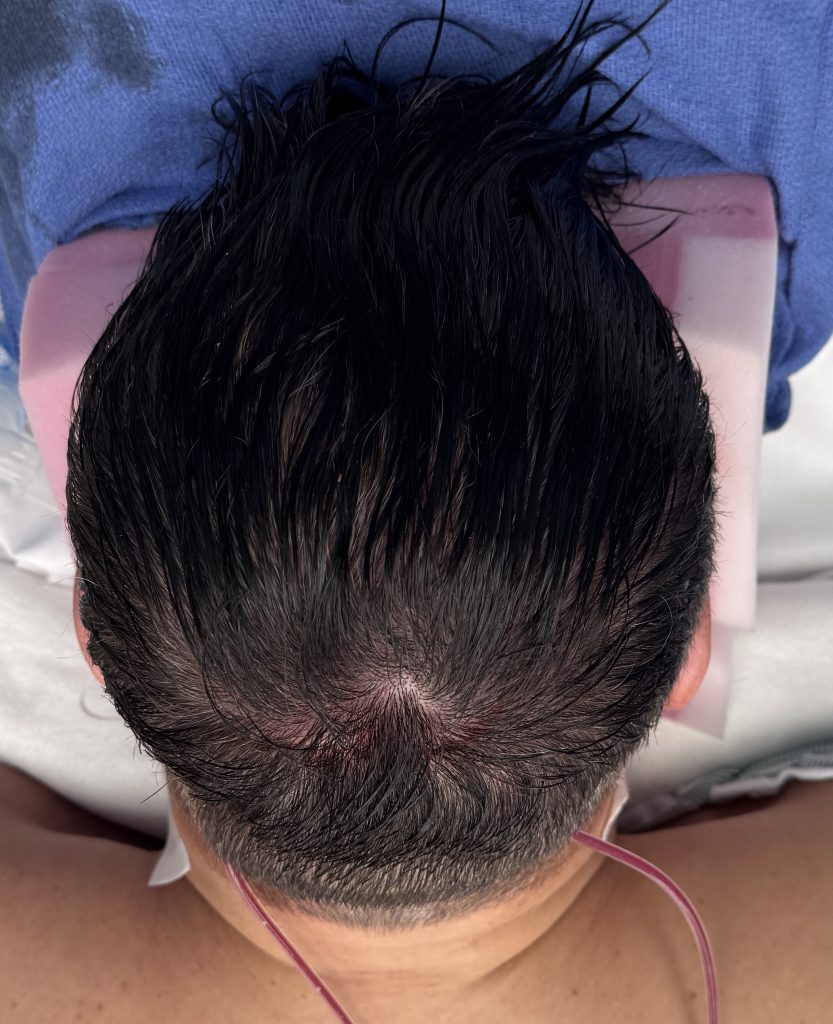 Plastic Surgery Case Study - The Male Wrap Around Head Widening Skull ...