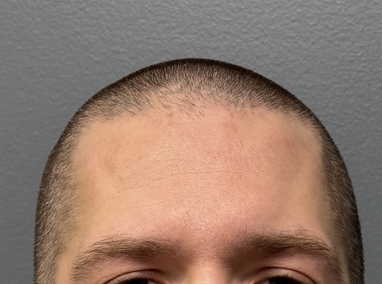 male forehead contouring front 1 Dr Barry Eppley - Explore Plastic Surgery