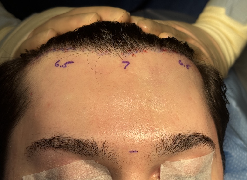male forehead length markings Dr Barry Eppley - Explore Plastic Surgery