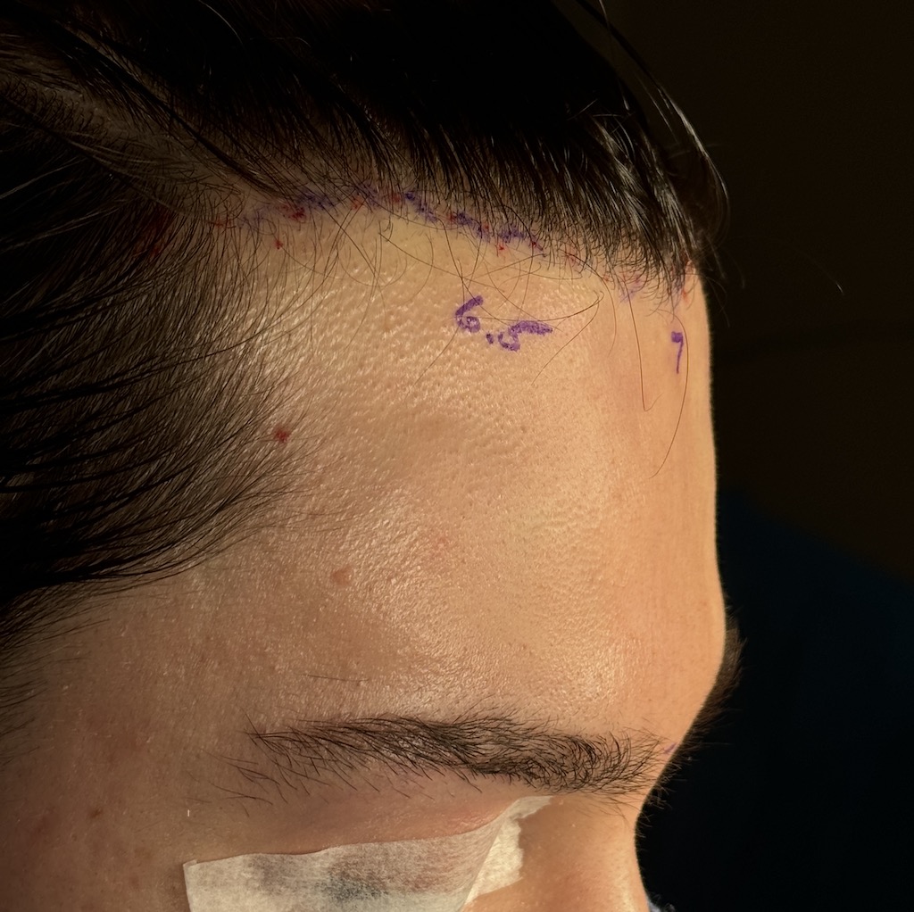 Plastic Surgery Case Study - Male Frontal Hairline Advancement ...