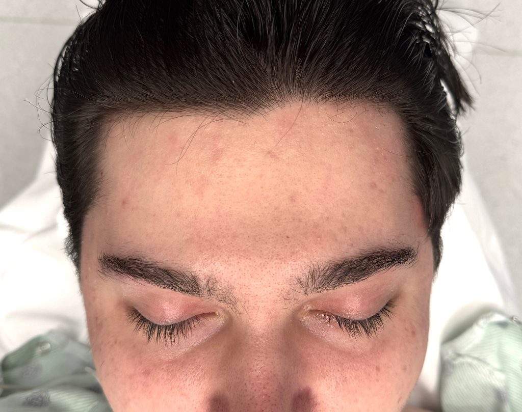 Plastic Surgery Case Study - Male Frontal Hairline Advancement ...