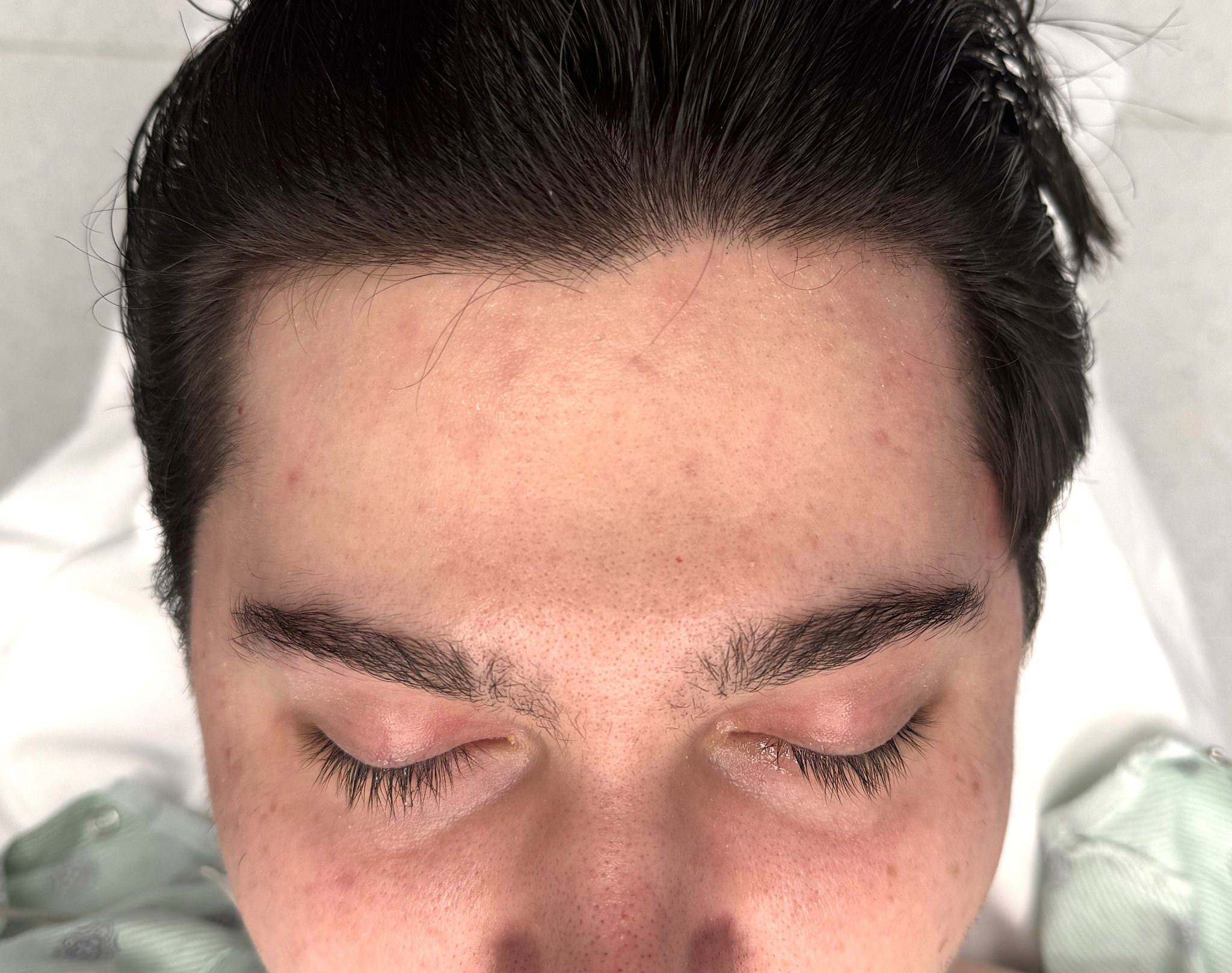 Plastic Surgery Case Study - Male Frontal Hairline Advancement ...
