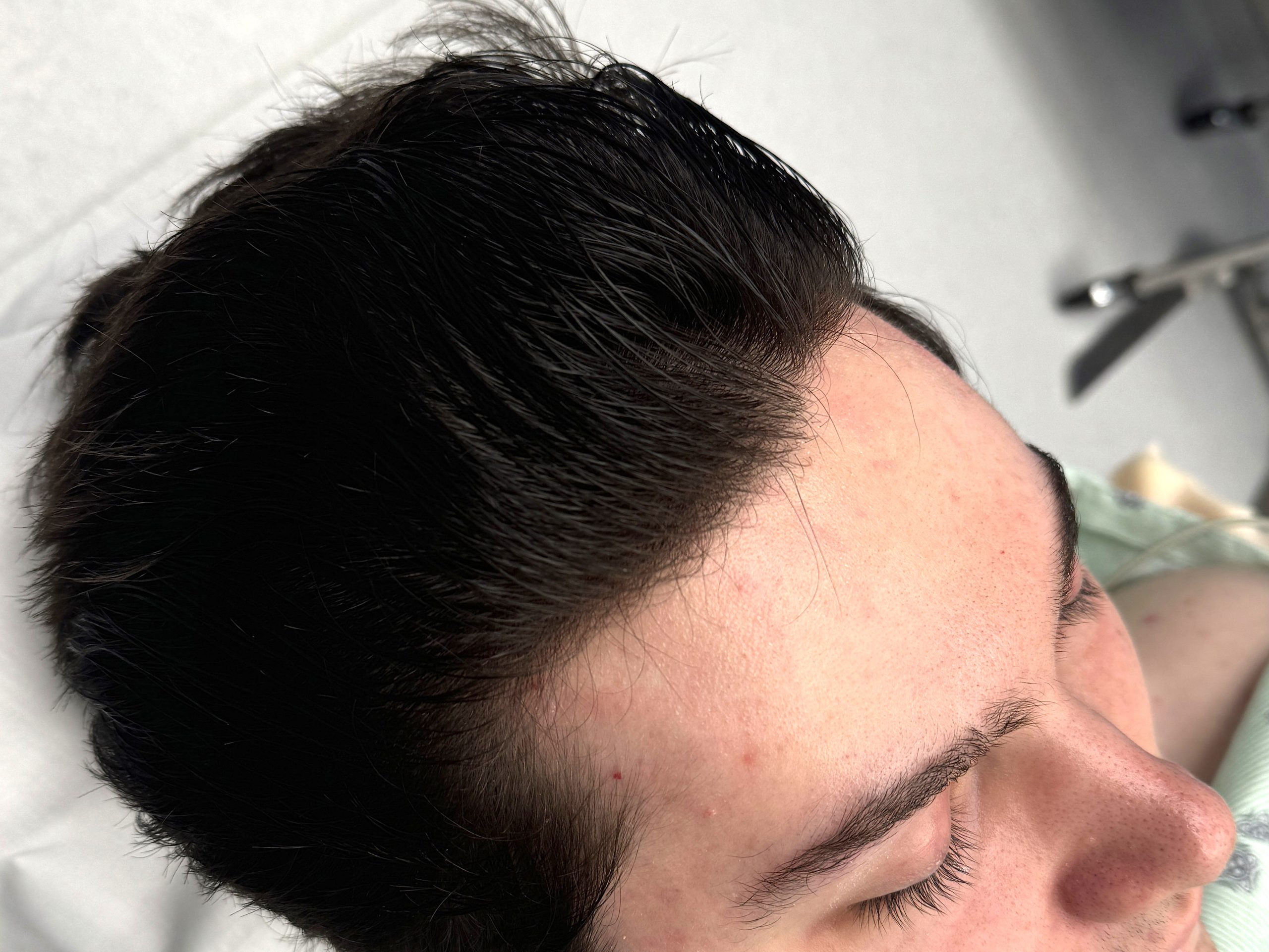male frontal hairline advancement oblique 1 Dr Barry Eppley - Explore ...