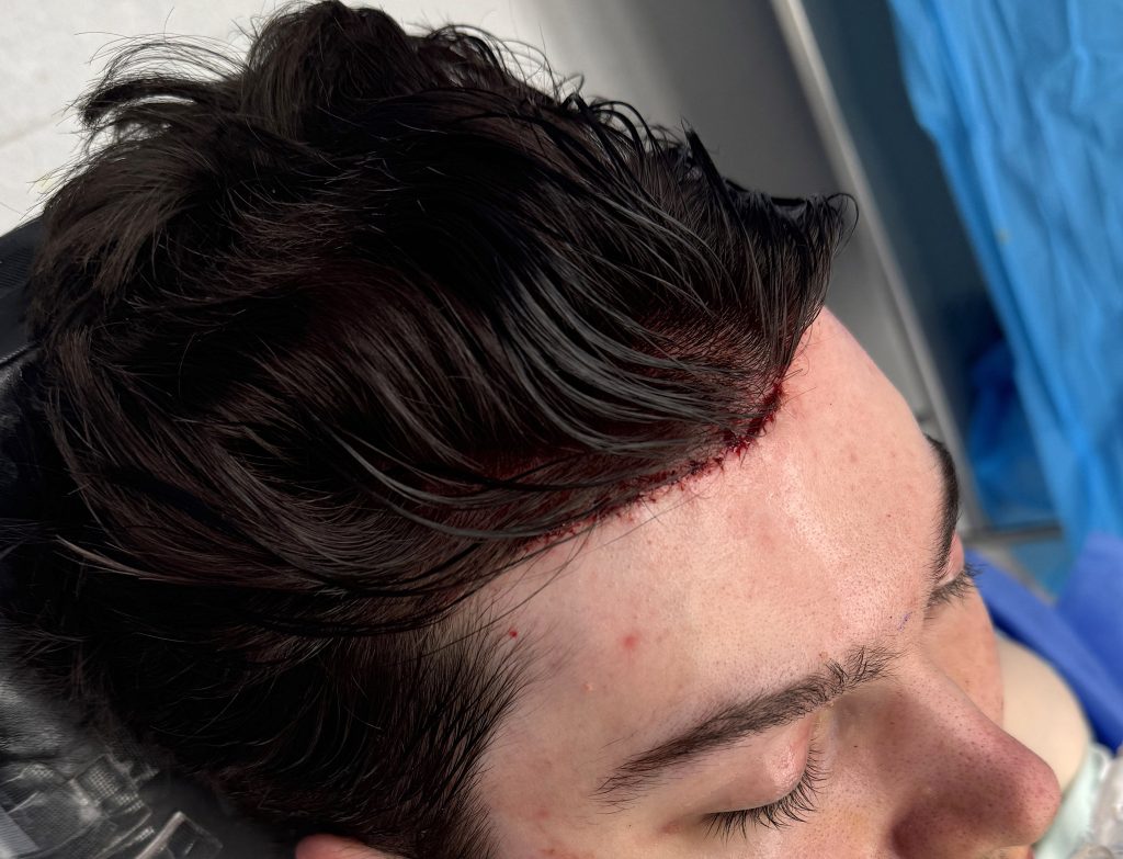 Plastic Surgery Case Study - Male Frontal Hairline Advancement ...