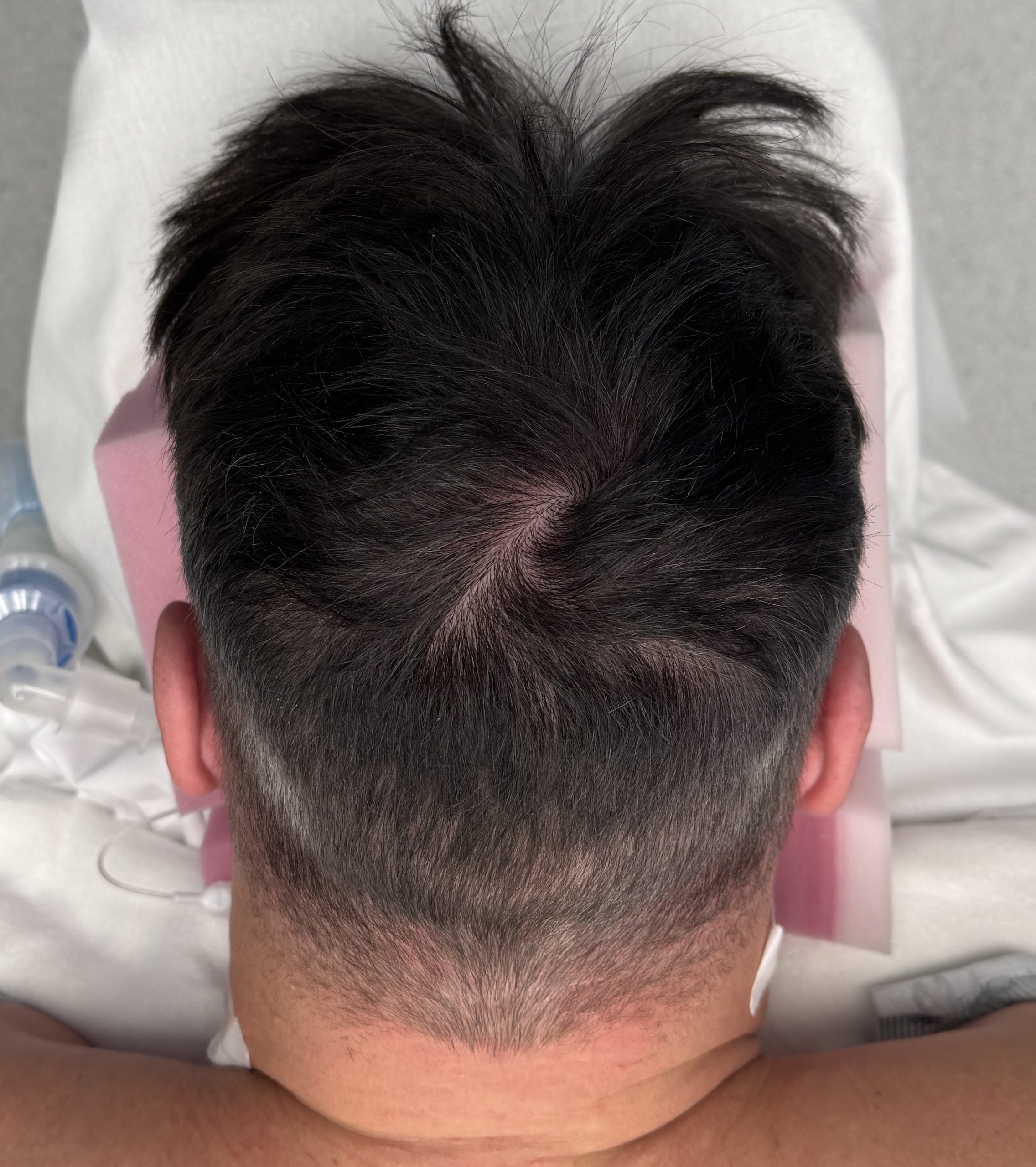 male narrow head shape top view Dr Barry Eppley - Explore Plastic Surgery