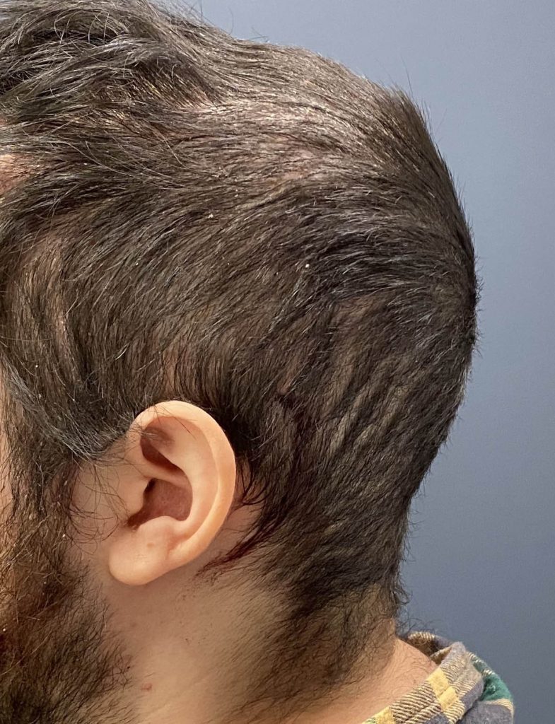 Plastic Surgery Case Study - Male Occipital Skull Reduction Through A ...