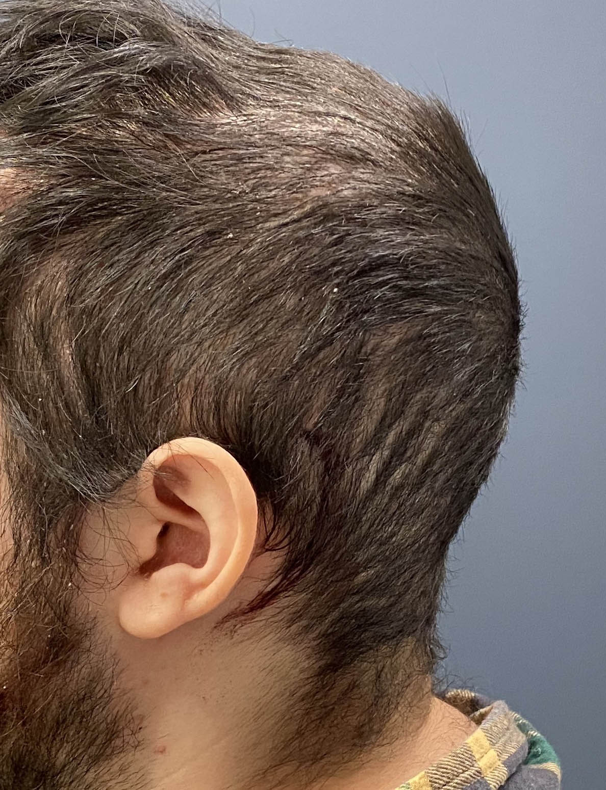 Plastic Surgery Case Study - Male Occipital Skull Reduction Through A ...