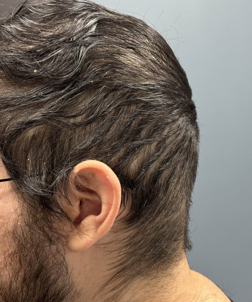 Plastic Surgery Case Study - Male Occipital Skull Reduction Through A ...
