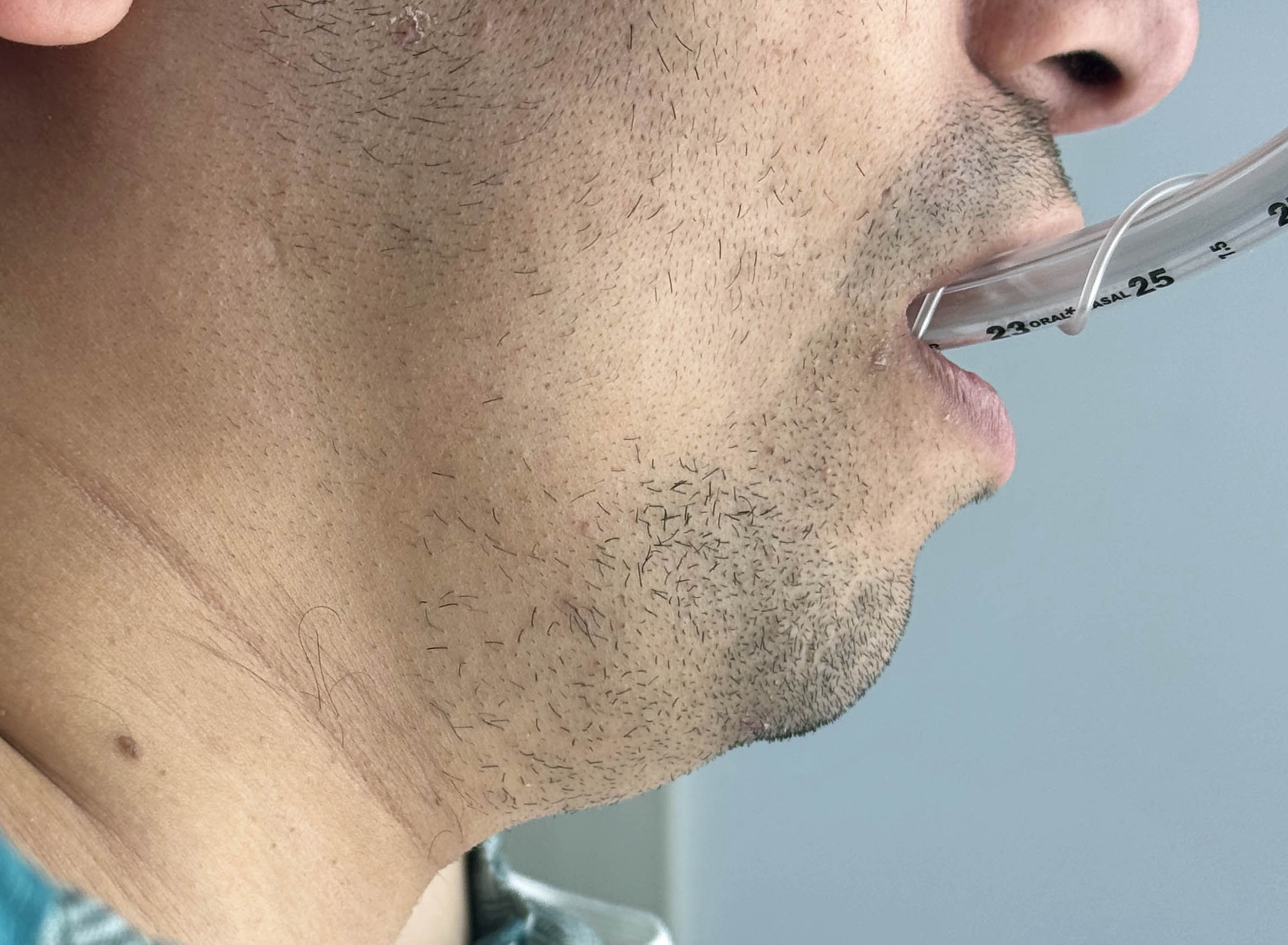 male sliding genioplasty witb sub,ental liposuction intraop side 1 Dr ...