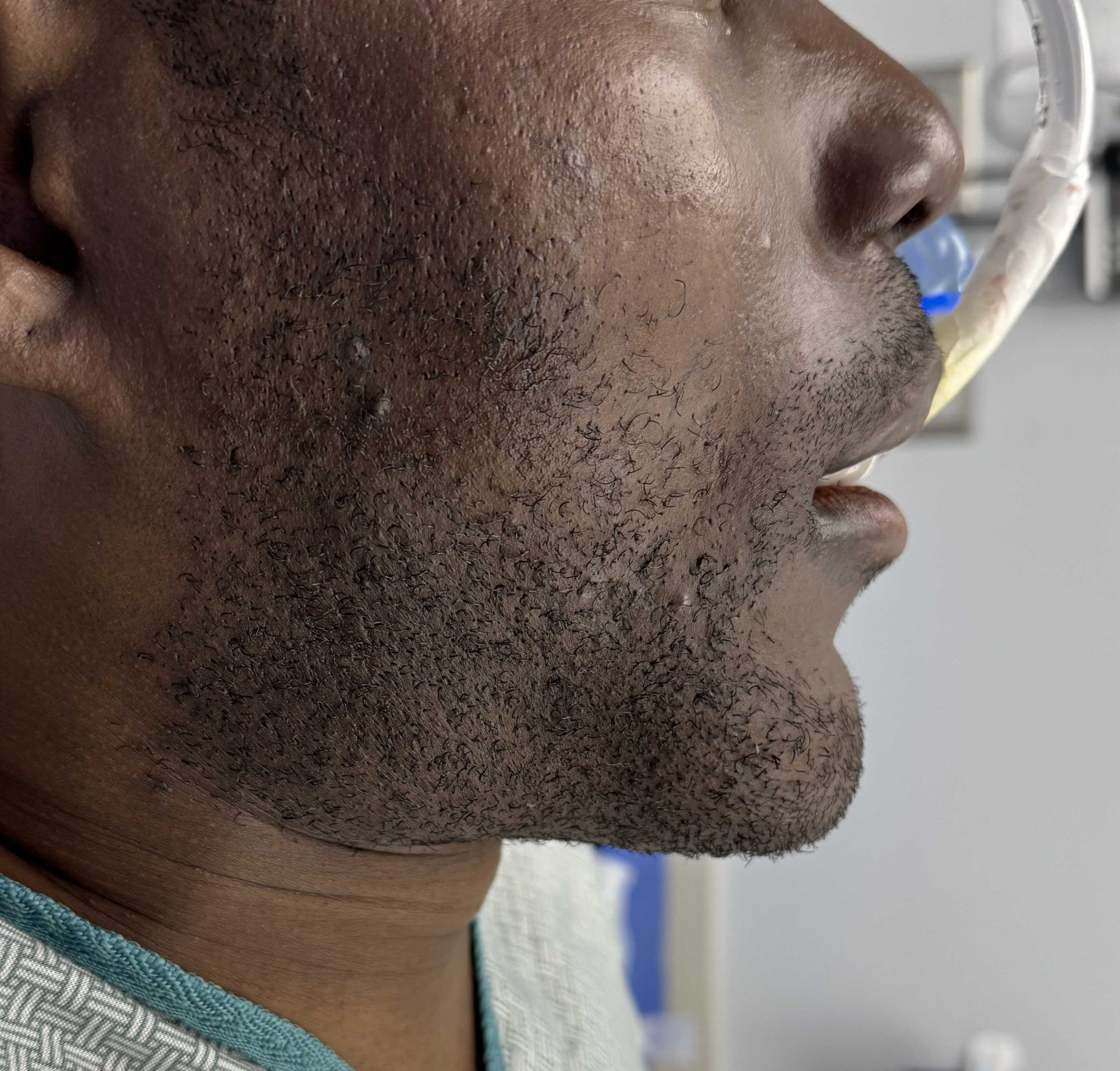Plastic Surgery Case Study - Combined Sliding Genioplasty and Implant ...