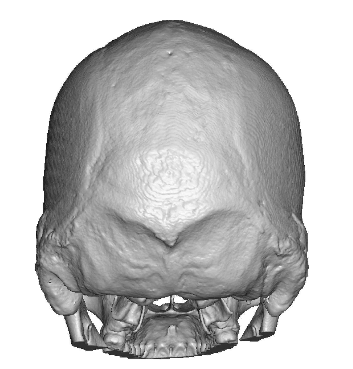 narow head shape 3D CT scan back view Dr Barry Eppley - Explore Plastic ...