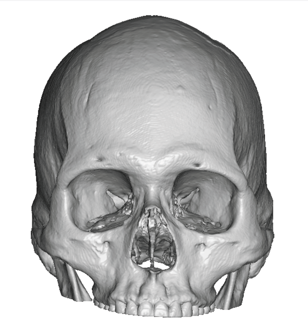 Plastic Surgery Case Study - Large Four Piece Head Widening Implant ...