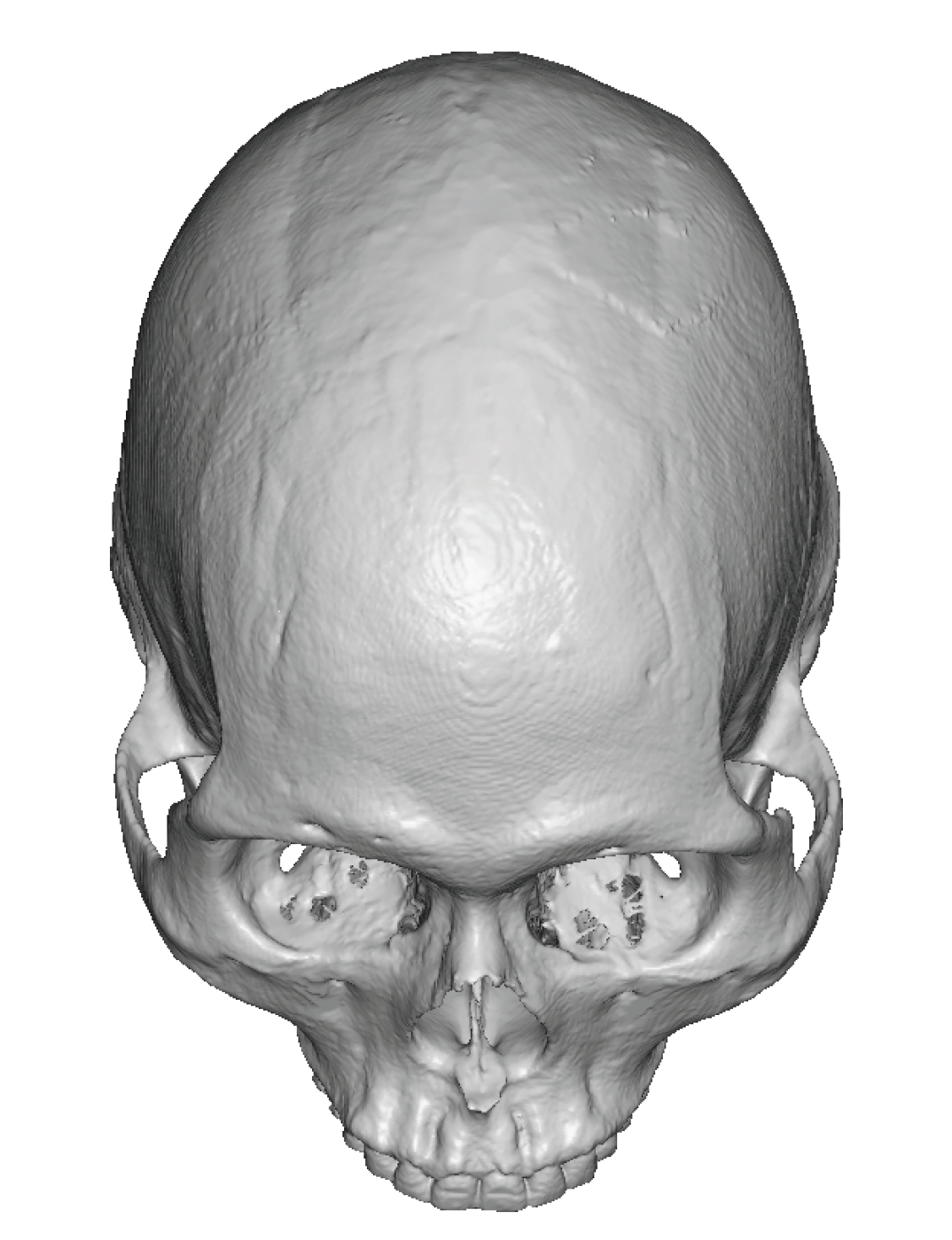 Plastic Surgery Case Study - Large Four Piece Head Widening Implant ...