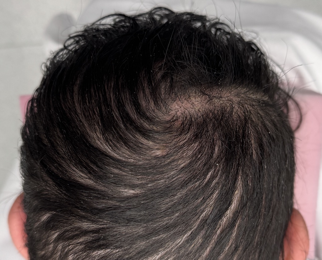 occipital scalp healed incision Dr Barry Eppley - Explore Plastic Surgery