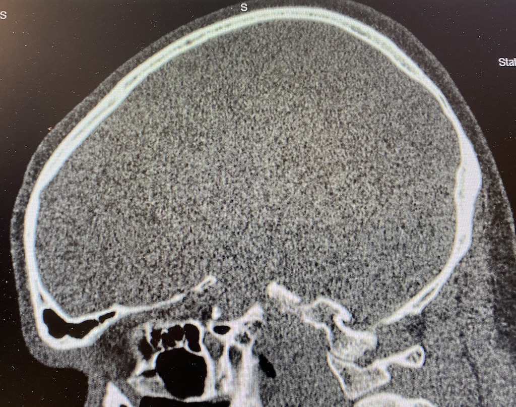 occiptal skull reduction postop CT scan Dr Barry Eppley - Explore ...