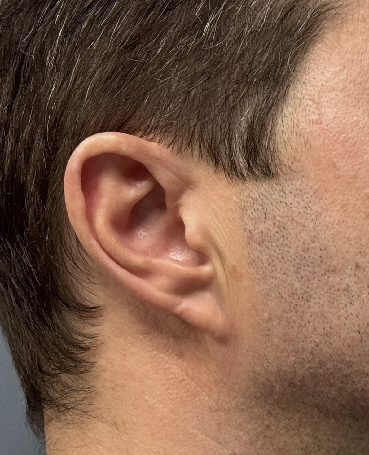 right congenital pixie ear Dr Barry Eppley - Explore Plastic Surgery