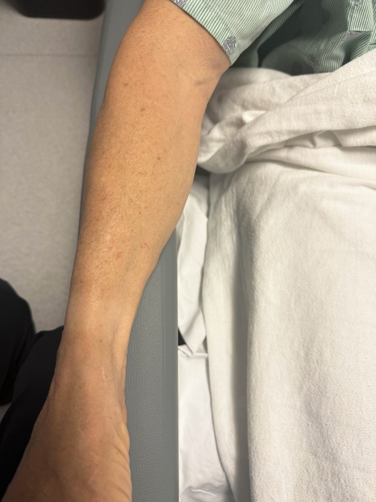 Plastic Surgery Case Study - Bilateral Upper Forearm and Right Volar ...