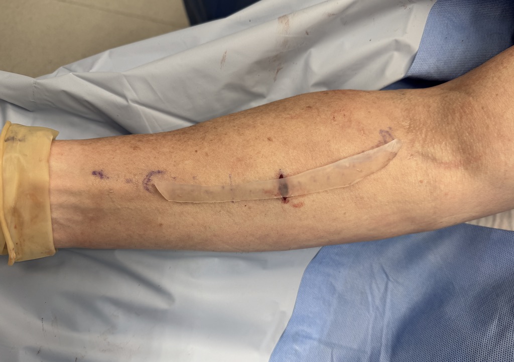 right volar forearm implant intraop Dr Barry Eppley - Explore Plastic ...