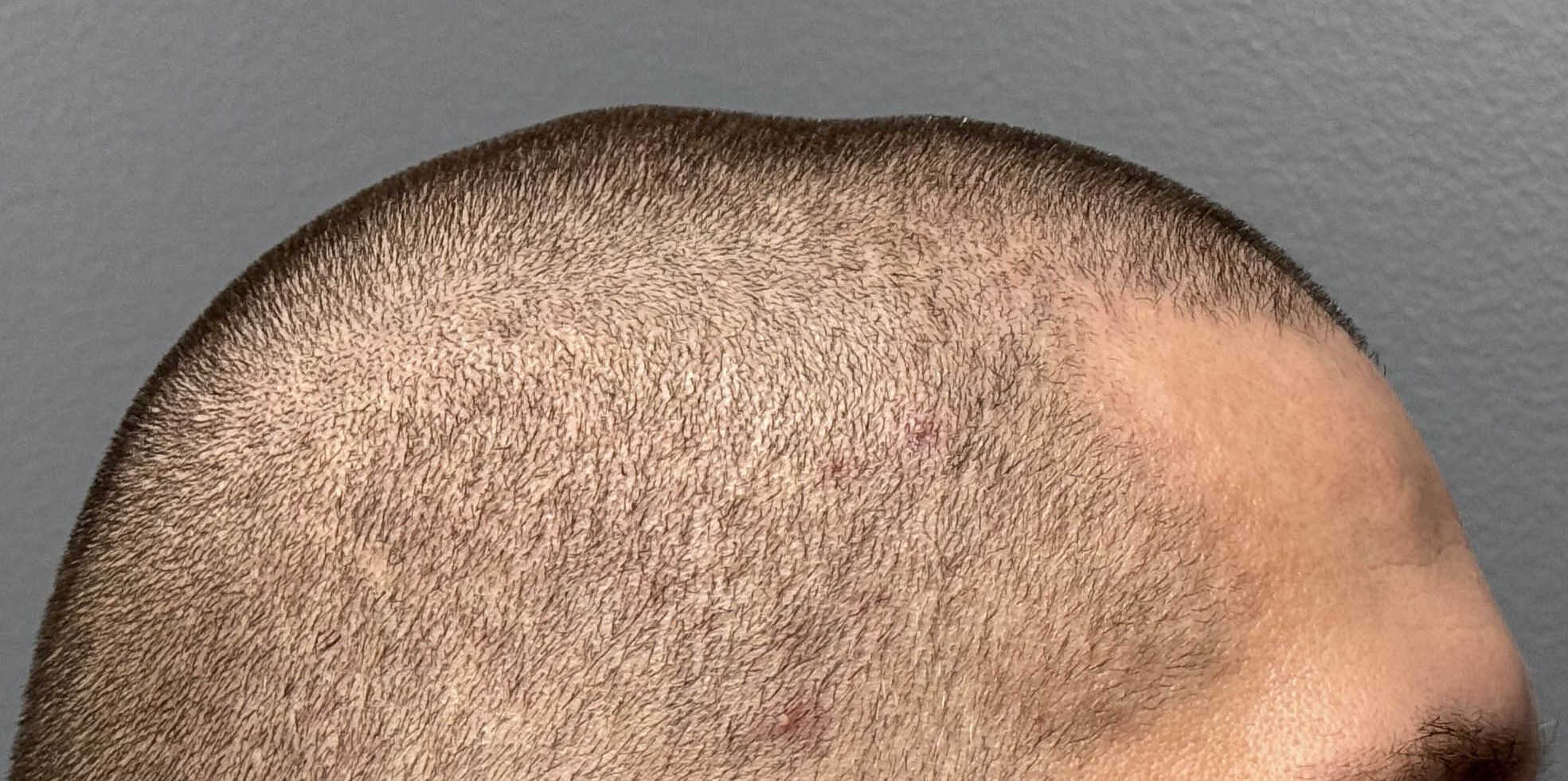 sagittal crest parsagittal dent skull deformity side view Dr Barry ...