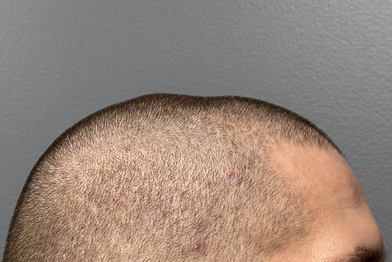 sagittal crest parsagittal dent skull deformity side view Dr Barry ...