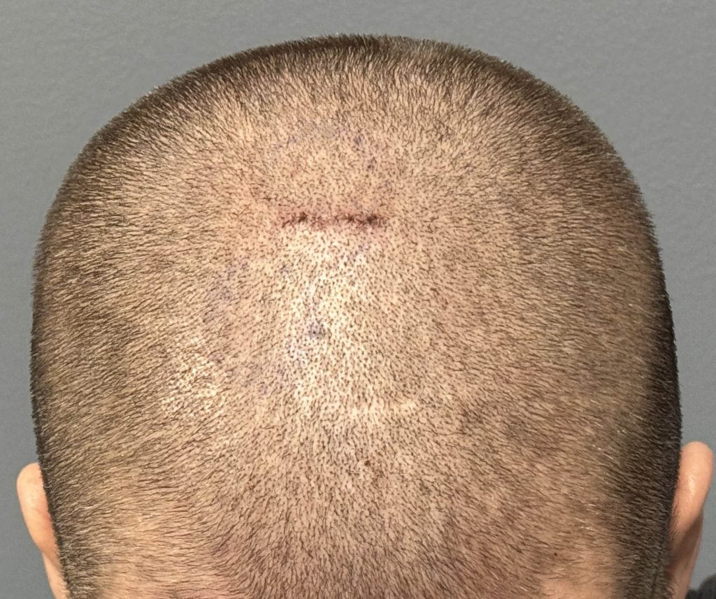 Plastic Surgery Case Study - Combined Sagittal Bump and Parasagittal ...