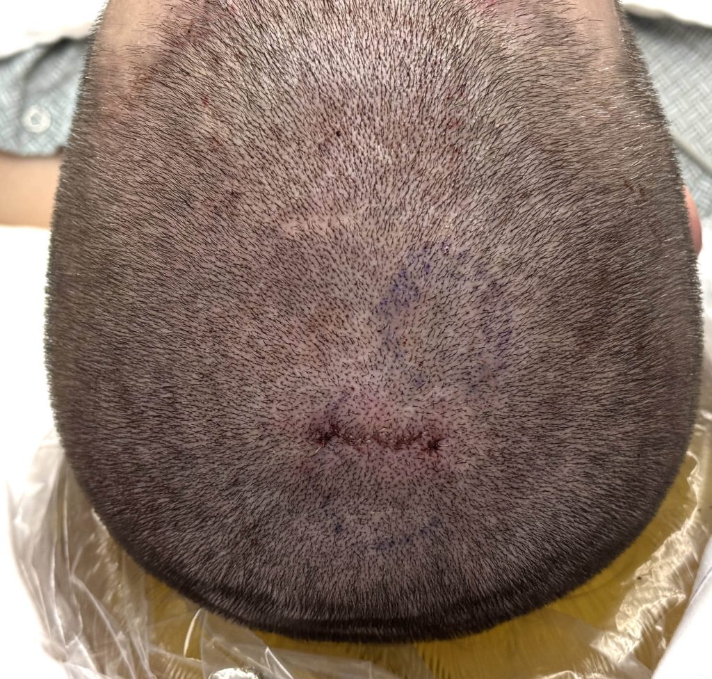 Plastic Surgery Case Study - Combined Sagittal Bump and Parasagittal ...