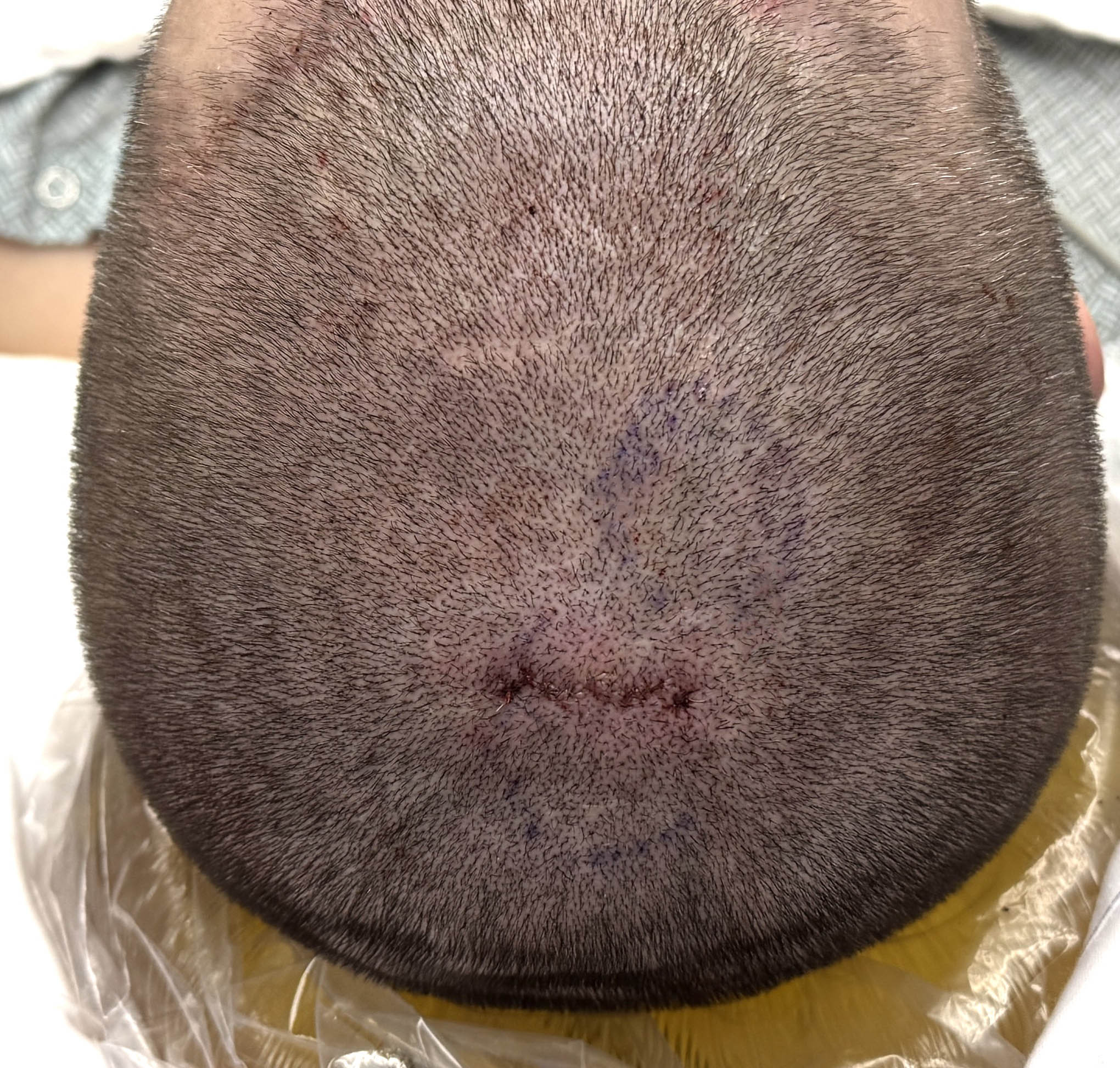 Plastic Surgery Case Study - Combined Sagittal Bump and Parasagittal ...