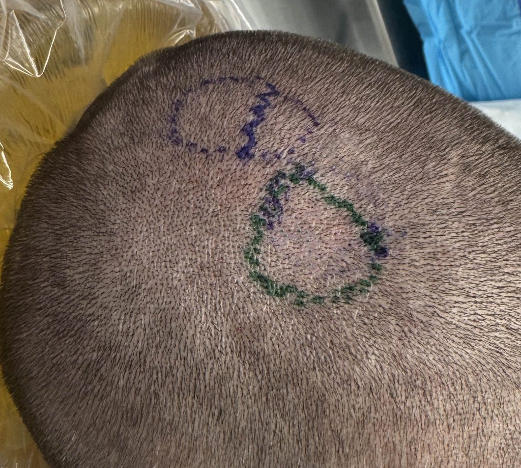 Plastic Surgery Case Study - Combined Sagittal Bump and Parasagittal ...