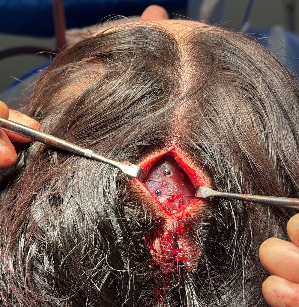 sagittal incision for csutom skull implant placement Dr Barry Eppley ...