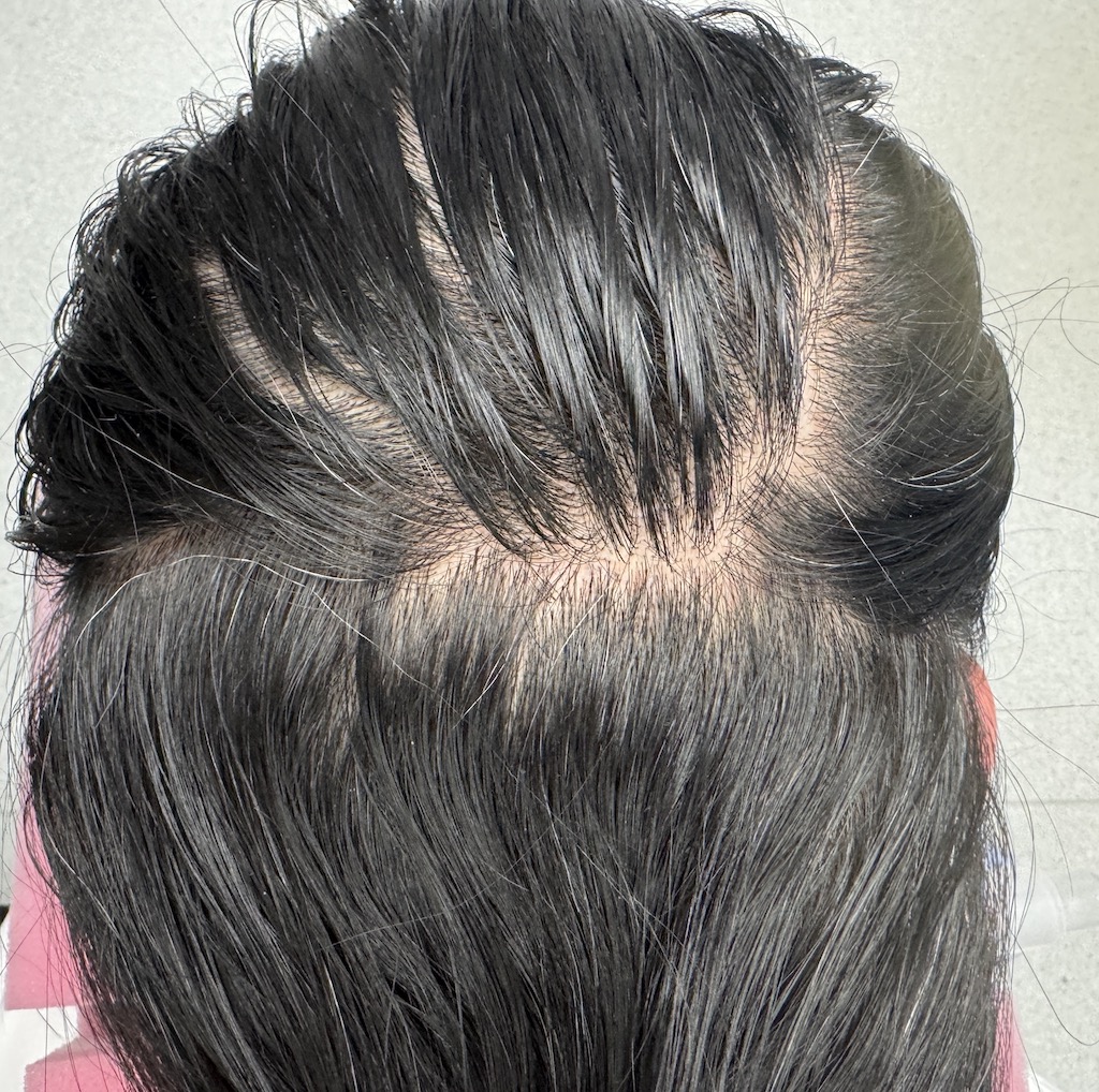 Plastic Surgey Case Study - Large Four Piece Skull Implant for Back and ...