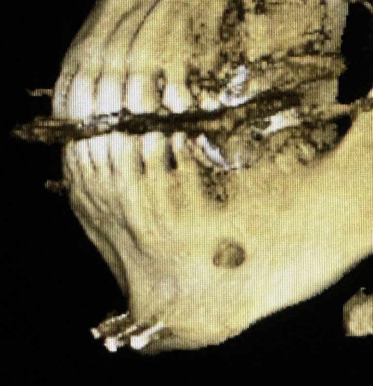 Plastic Surgery Case Study - Combined Sliding Genioplasty and Implant ...