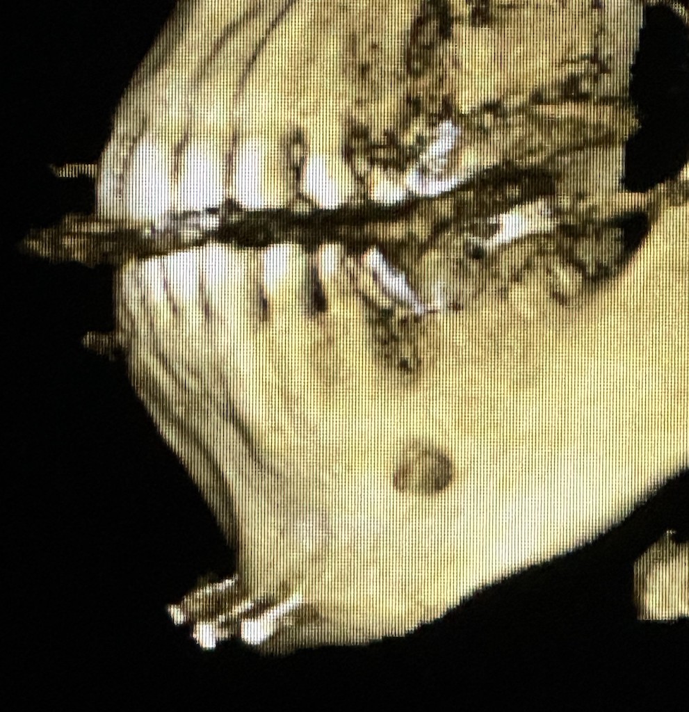 screw fixation chin implant 3D CT scan side view Dr Barry Eppley ...
