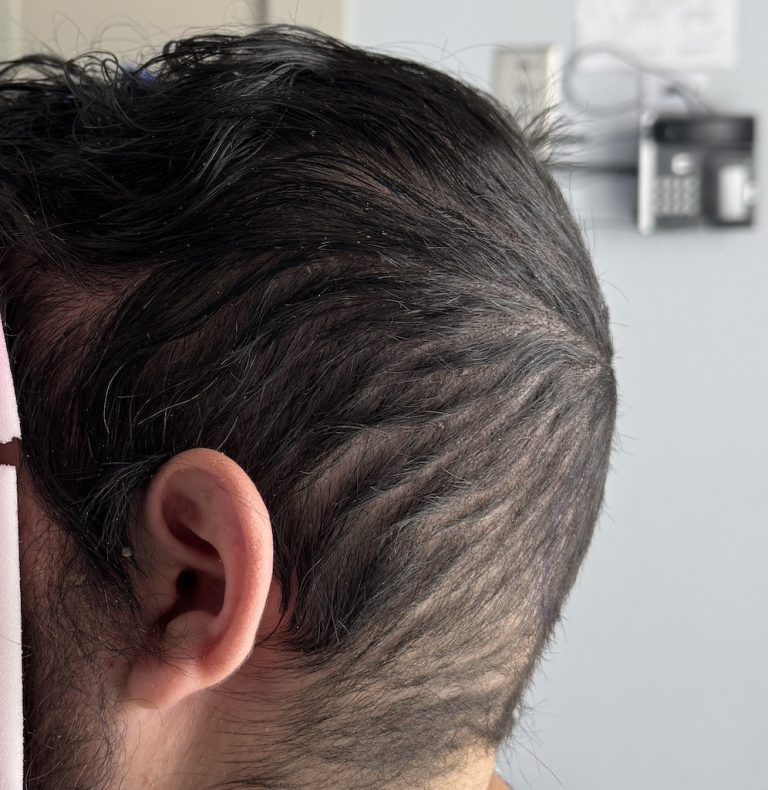 Plastic Surgery Case Study - Secondary Occipital Knob and Bun Reduction ...