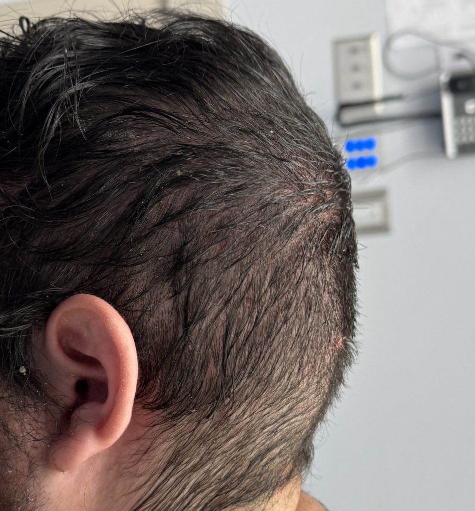Plastic Surgery Case Study - Secondary Occipital Knob and Bun Reduction ...