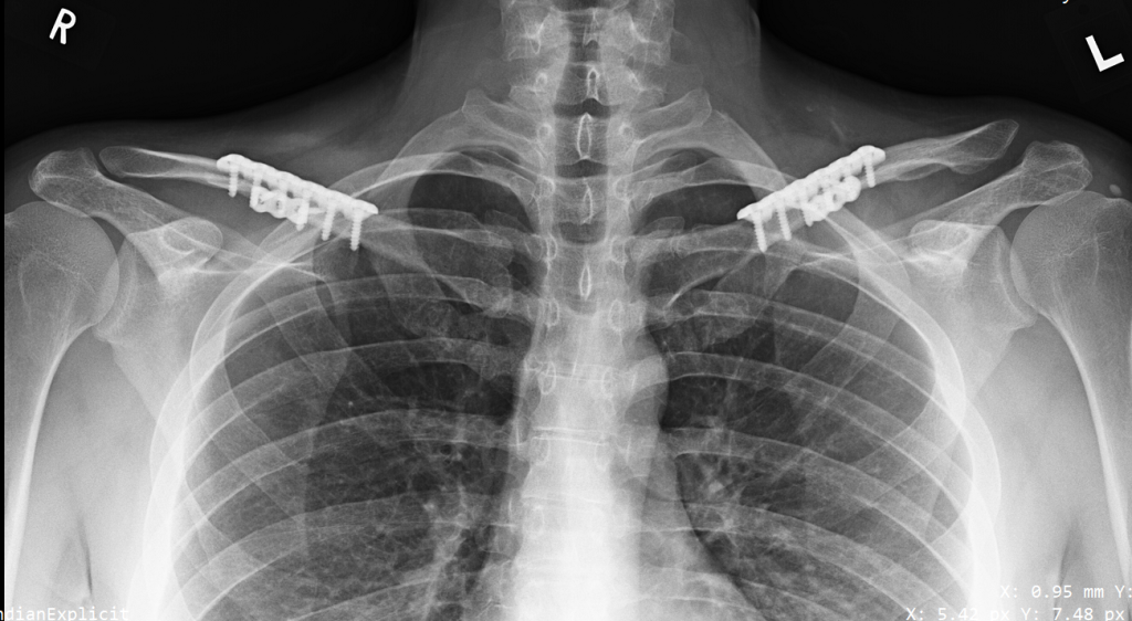 Plastic Surgery Case Study - Evaluating the Roll In Effect of Shoulder ...