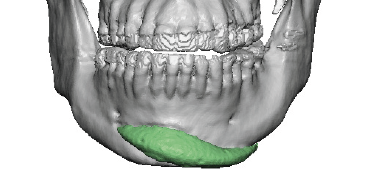 Plastic Surgery Case Study - Custom Square Chin Implant Replacement for ...