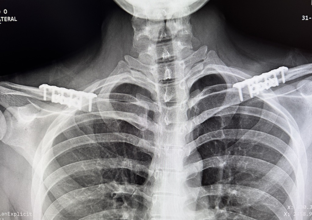 The Postoperative X-Ray in Clavicle Reduction Shoulder Reshaping ...