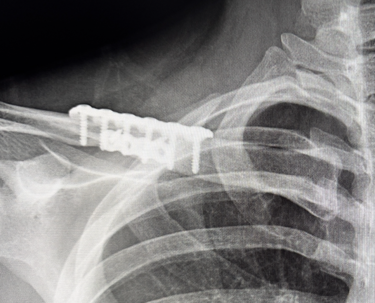 The Postoperative X-Ray in Clavicle Reduction Shoulder Reshaping ...
