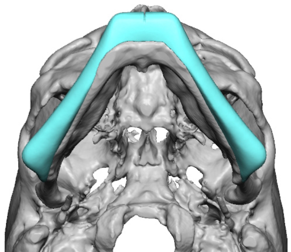 custom jawline implant design submental view DR Barry Eppley - Explore ...