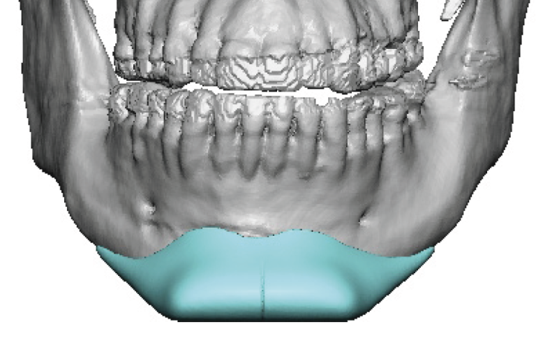 Plastic Surgery Case Study - Custom Square Chin Implant Replacement for ...