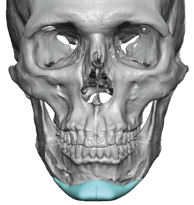 PLastic Surgery Case Study - Correcting Chin Implant Asymmetry and ...