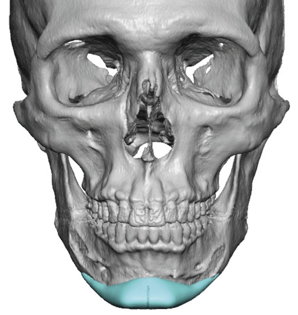 PLastic Surgery Case Study - Correcting Chin Implant Asymmetry and ...