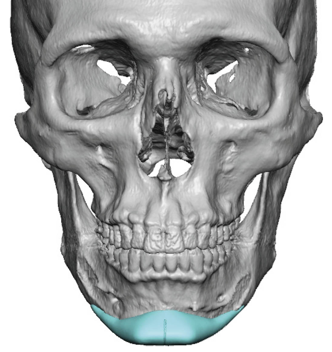 custom square chin implant design front view Dr Barry Eppley - Explore ...